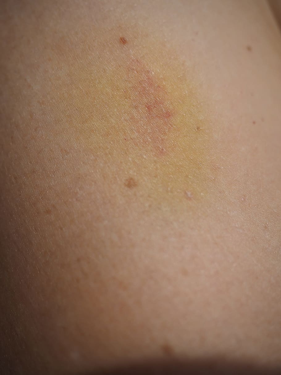 Download Blue Blot, Green, Haematoma, Discoloration, Skin, Yellow ...